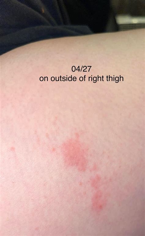 33f Got Shingles The First Time On My 33rd Birthday Feb 6th Yay Me