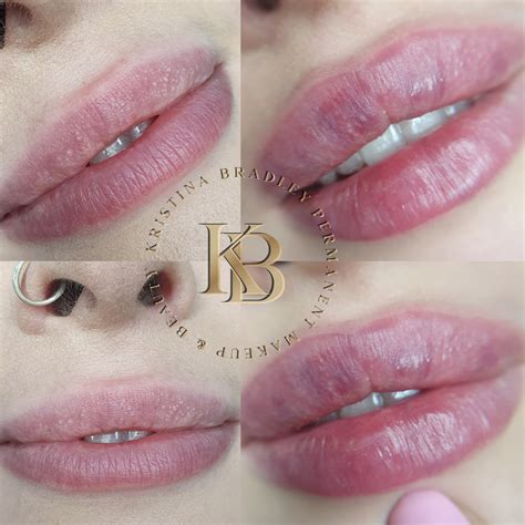 Russian Lips Warrington Lip Augmentation Kristina Bradley Spmu And Aesthetics