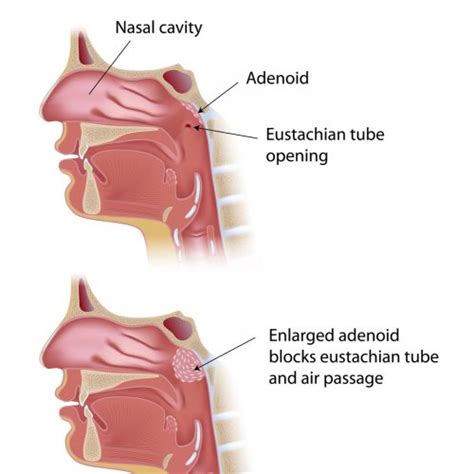Adenoid Hypertrophy Grading