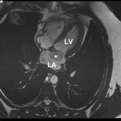 Four Chamber Postcontrast Cardiac Magnetic Resonance Imaging Revealing
