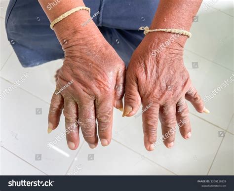 Salt And Pepper Appearance Scleroderma At Bob Bormann Blog