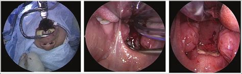 Tonsillectomy Procedure Step By Step Tonsillectomy Surgery In