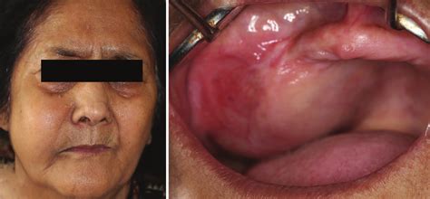 A Extraoral Examination Revealing A Diffuse Swelling On The Right
