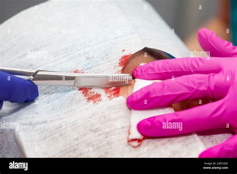 Doctor Suturing A Patient During A Small Surgery Dermatologist