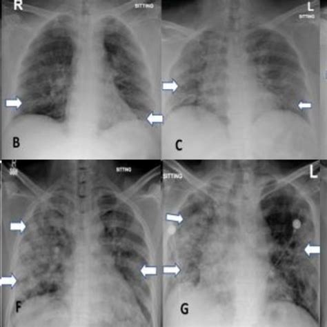 Cxr Patterns A Left Lower Zone Consolidation B Bilateral Lower Zone