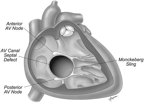 Arrhythmias In Adult Patients With Congenital Heart Disease Circulation