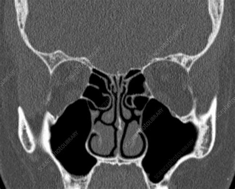 Normal Sinuses Ct Scan Stock Image C029 4638 Science Photo Library