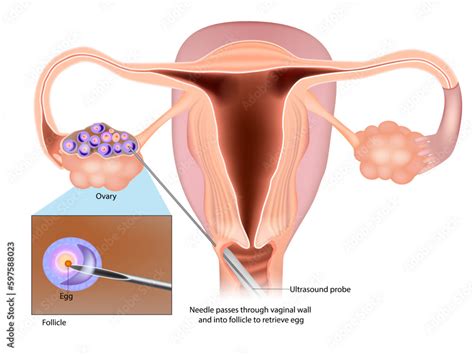Ivf Egg Retrieval Technique Egg Retrieval Procedure Before In Vitro