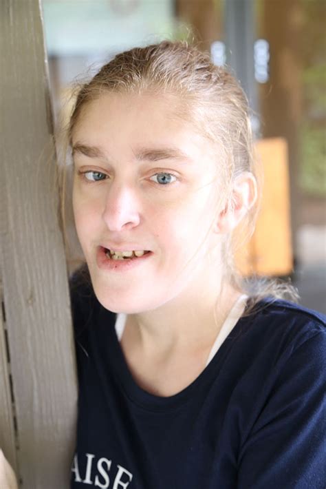 Coffin Siris Syndrome Positive Exposure