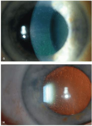 Corneal Degenerations And Deposits Ento Key