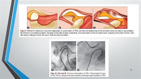 Temporo Mandibular Joint Dislocation And Ankylosispptx