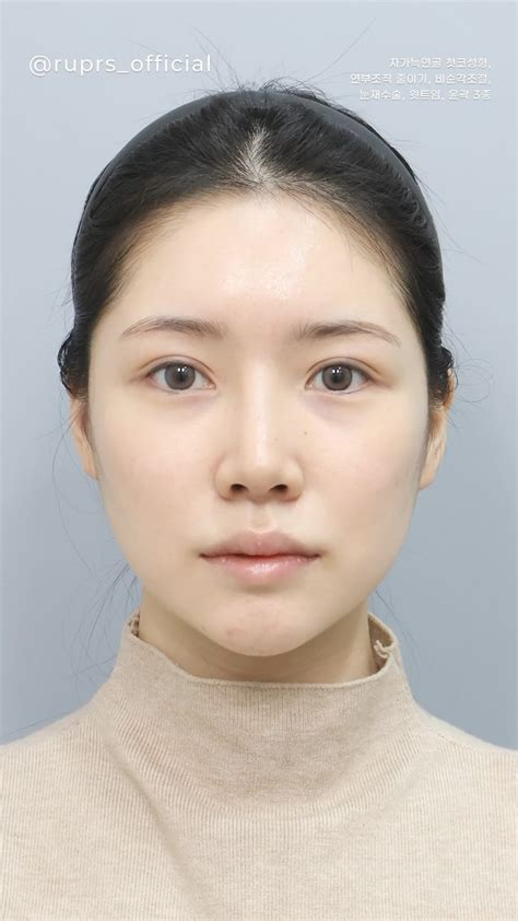 알유성형외과 코재수술·자가늑연골코성형·구축코·안면윤곽·리프팅 Ru With Us 윤곽이 부족한 메부리코를 개선하기 위해 내원하신 20대 남자분 넓은 어깨와 두꺼운