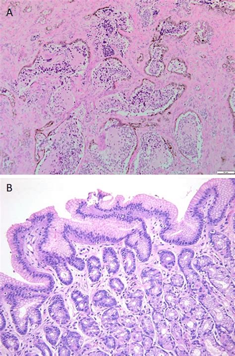 Melanotic Neuroectodermal Tumor Of Infancy