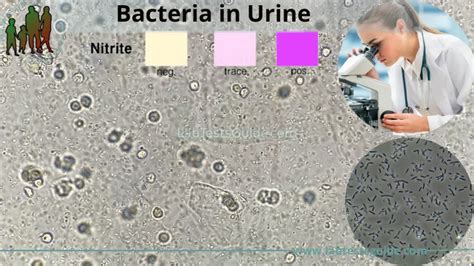 Bacteria In Urine Under Microscope