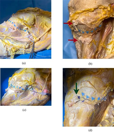Inferior Medial Genicular Artery Based Tibia Osteocutaneous Flap