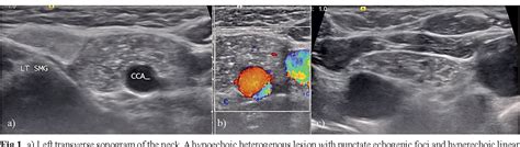 Ectopic Cervical Thymus As A Rare Cause Of Pediatric Neck Mass The