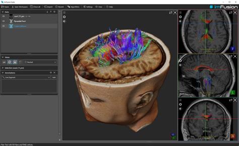 Imfusion Gmbh On Linkedin Sdk Medicalimaging Newplugin