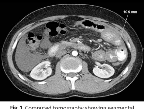 Figure 1 From Case Report Eosinophilic Enteritis A Rare Cause Of