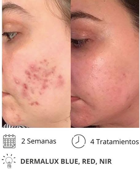 Dermalux Md Flex Fototerapia Sellaesthetic