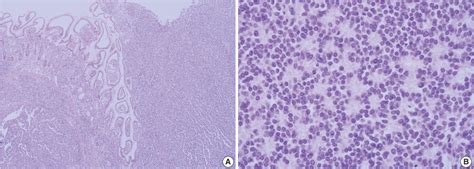 Figure 2 From Peripheral Primitive Neuroectodermal Tumor With Osseous Component Of The Small