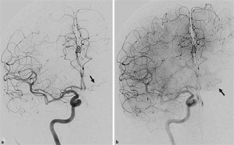 15 The Recurrent Artery Of Heubner Radiology Key