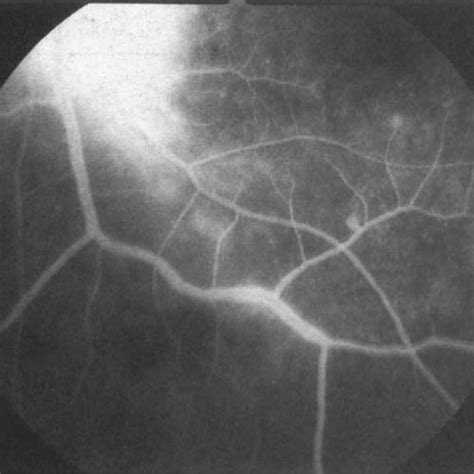 Case 2 Severe Ischaemic Retinal Vasculitis Fluorescein Angiogram Of