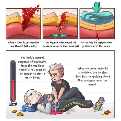 How To Control A Major Bleed Artofit