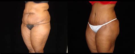 Mommy Makeover Before And After Photos Baltimore Plastic Surgery