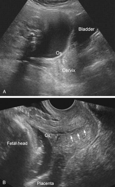 Ultrasound Evaluation Of The Placenta Membranes And Umbilical Cord