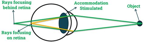 Hyperopia Why Hyperopic Accept Under Correction During Refraction