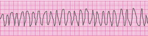 Acls Tachycardia Wide Complex Ventricular The Common Vein