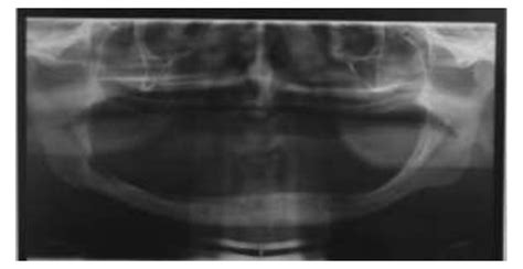 The Panoramic Radiography Reveled Bone Rarefaction Measuring Around 20