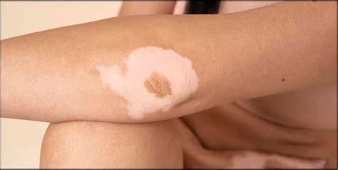 Can Vitiligo Be Caused By Medication Kayakalp