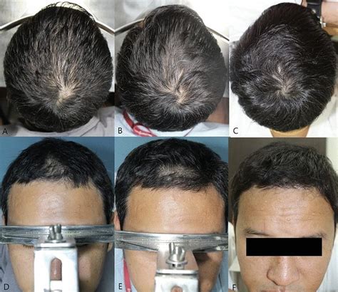 Minoxidil Hair Treatment Side Effects At David Greenfield Blog