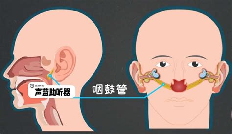 咽鼓管堵塞？