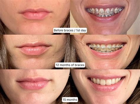 Before And After 15 Months Of Braces For Class 2 2 Malocclusion Deep Bite Scrolller