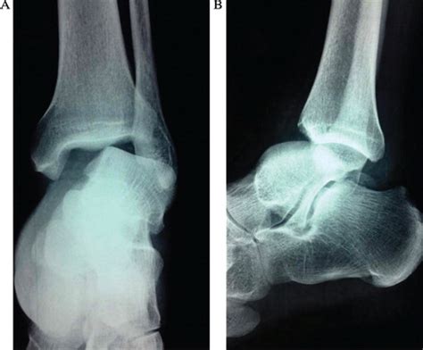 Tibiotalar Joint Dislocation