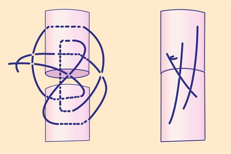 Common Suture Patterns Surgmedia
