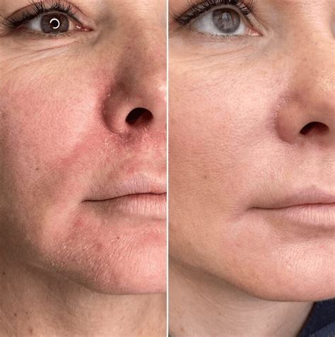 Prx T33 Peel Face Treatments ⚕️london Cost £75 Before And After