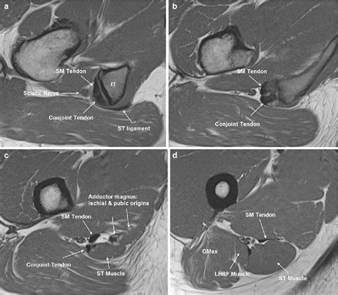Hamstring Tendon Mri
