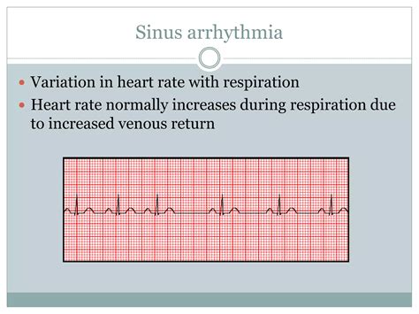 Interpretation Of Common Ecg Abnormalities PPTX