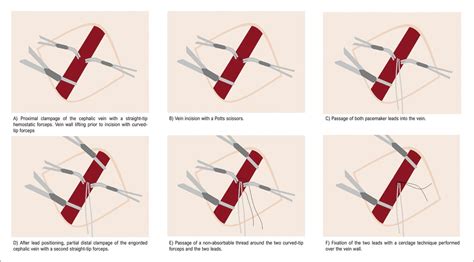 New Technique For Preserving Cephalic Vein Flow In Pacemaker