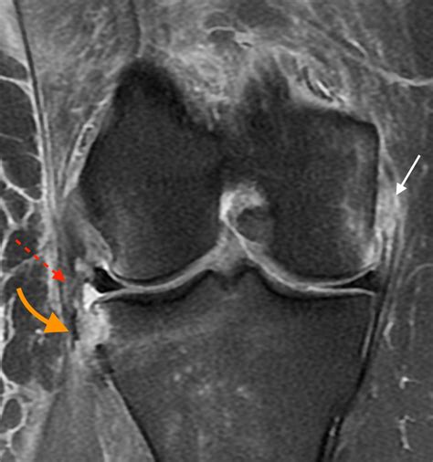 Fibular Collateral Ligament Mri