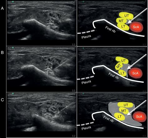 Ultrasound Guided Supraclavicular Perivascular Block Anatomical