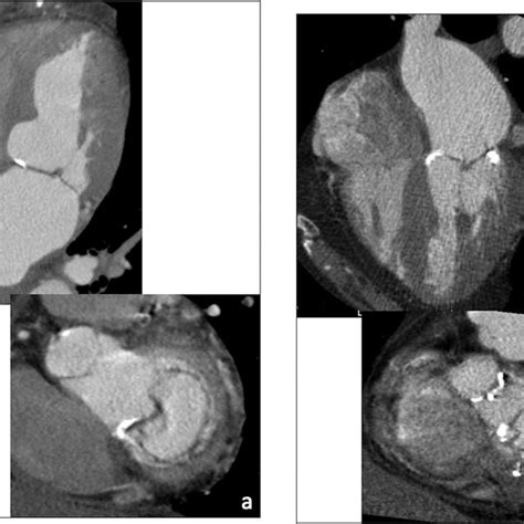 A Mild And B Moderate Mac As Shown By 4 Chamber Upper And Short Download Scientific