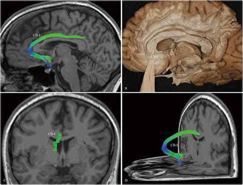 In Vivo Fiber Tractography And Fiber Dissection Of The Cb I Ab The
