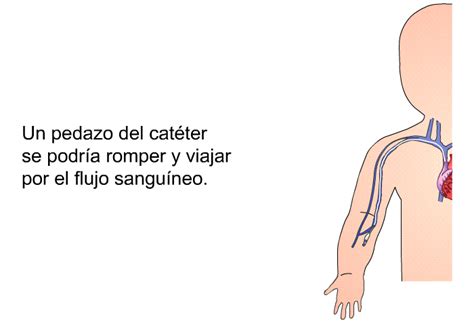 Catéter Central De Inserción Periférica Picc Pediatría