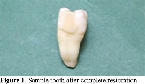 Figure 1 From Effect Of Different Gingival Margin Restorations Of Class Ii Cavities On