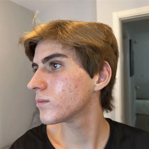 Accutane 40 Mg Day 4 Mo 26 D Micro Needling 16 D Progress R Accutane
