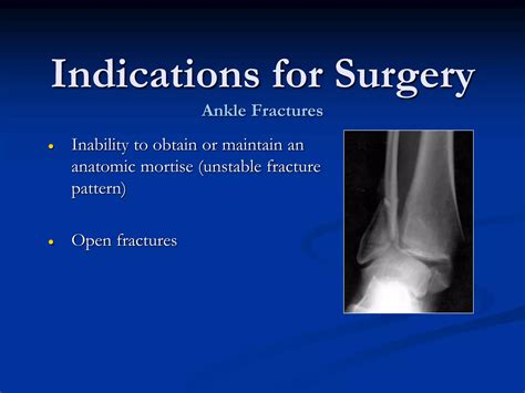 Fracture Of Tibiaankle And Footppt
